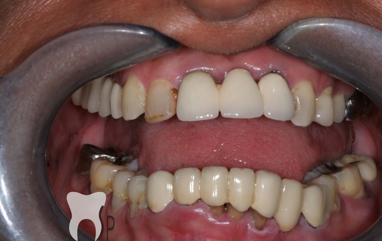 Case 5: The case of “flapping teeth” - Dr. Shailaja Prasad's Dental ...